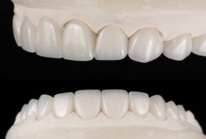 Veneer Bonding Tips & Techniques Expert Help | Smile Art Lab