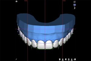 Understanding Smile Design